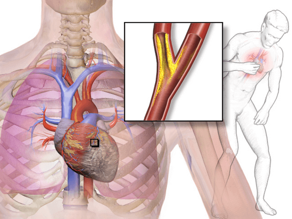 Angina Disease With Causes Treatment And Nursing Intervention